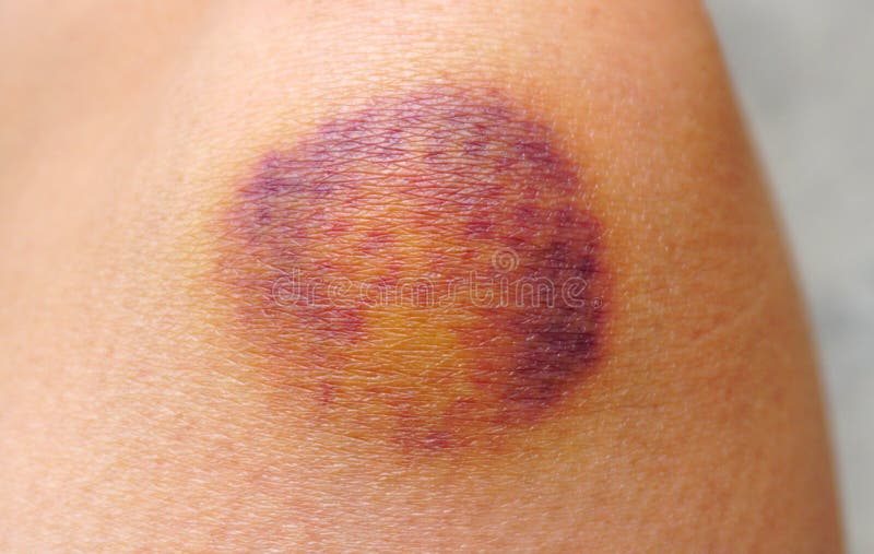 9,474 Contusion Photos libres de droits et gratuites de Dreamstime