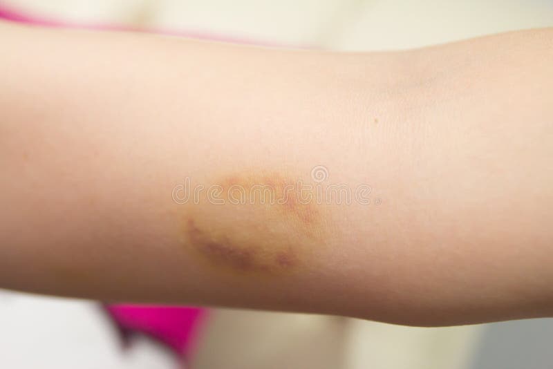 La Blessure De Bleu Sur La Peau Supérieure Du Bras Oscillant De ...