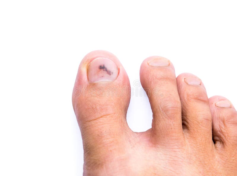Contusion Sur Le Clou D'orteil Sur Le Fond Blanc Photo stock - Image du ...