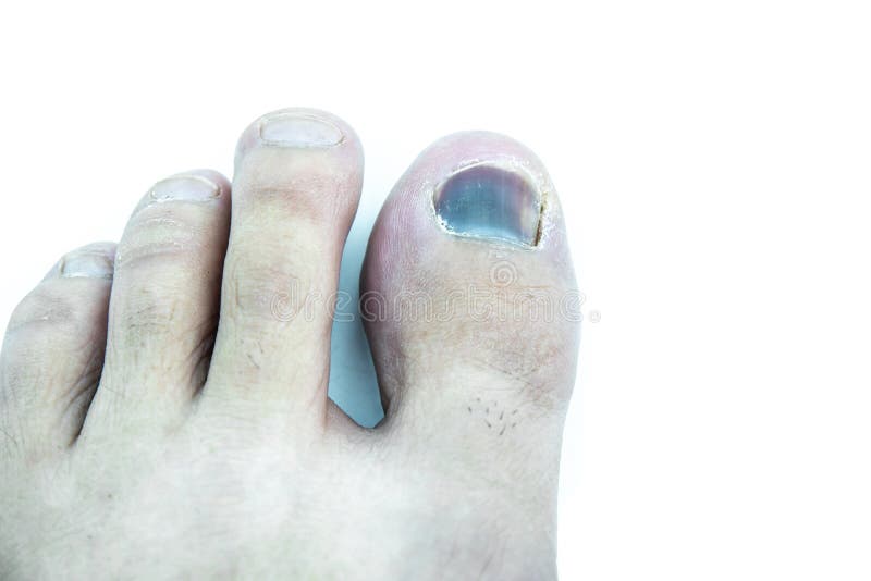 Contusion Sur Le Clou D'orteil Sur Le Fond Blanc Image stock - Image du ...