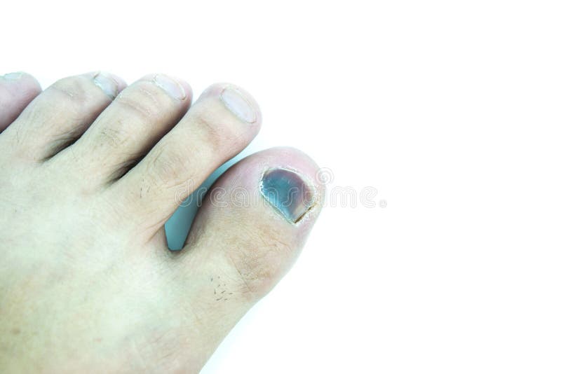 Contusion Sur Le Clou D'orteil Sur Le Fond Blanc Photo stock - Image of ...