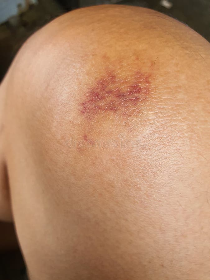 La Contusione Sul Suo Ginocchio La Contusione Sulla Sua Gamba ...