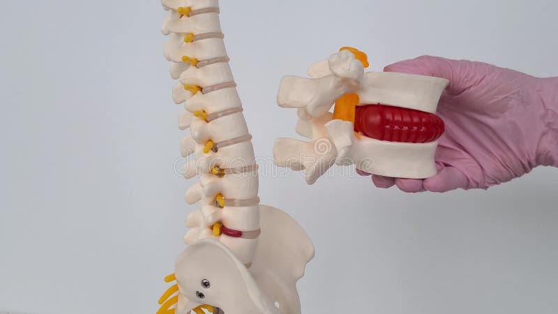 Convex Red Intervertebral Disc Herniation on Model of Spine Stock Video ...