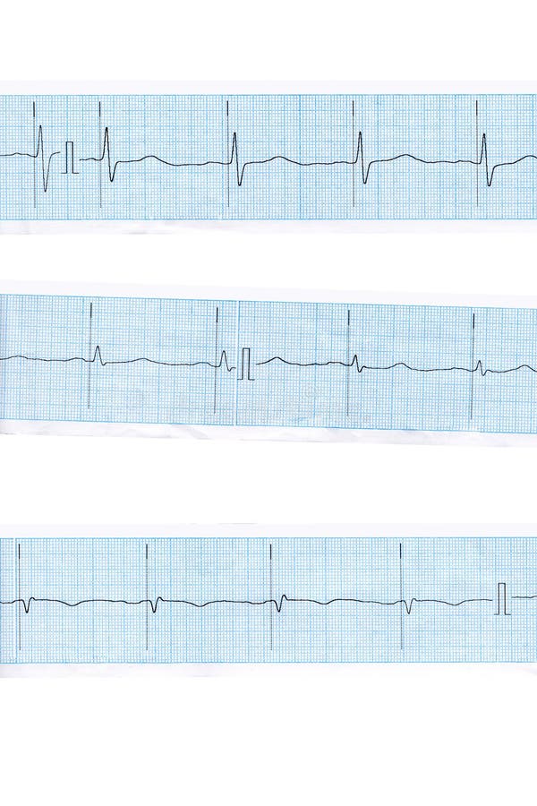 Cardiograma. Esquema Del Análisis Del Corazón Imagen de archivo ...