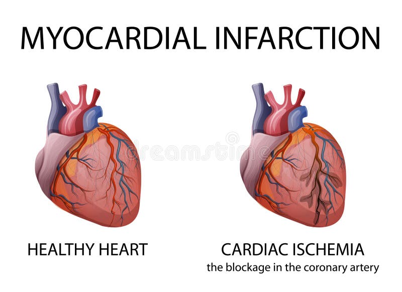 Corazón Infarto Del Miocardio Ilustración del Vector - Ilustración de ...