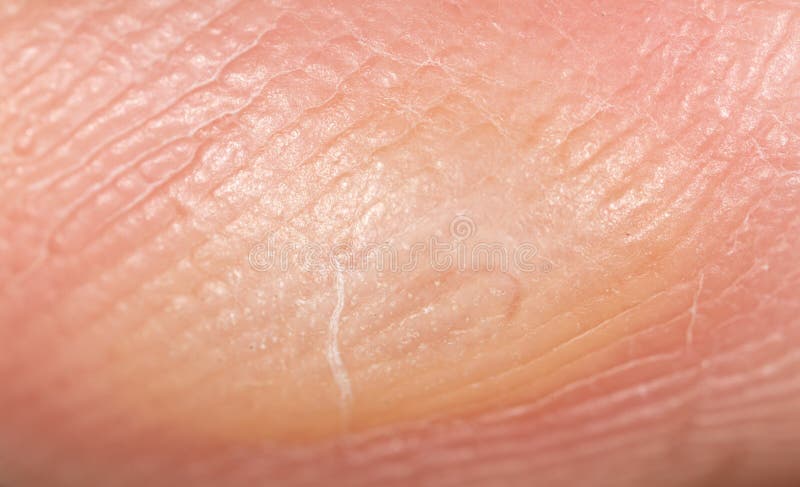 Corn on a Finger Isolated on a White B Stock Image - Image of wound ...