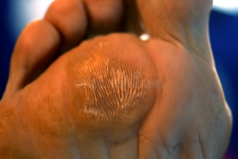 Corn on the Foot. Foot Sole with Corn. Stock Image - Image of finger ...