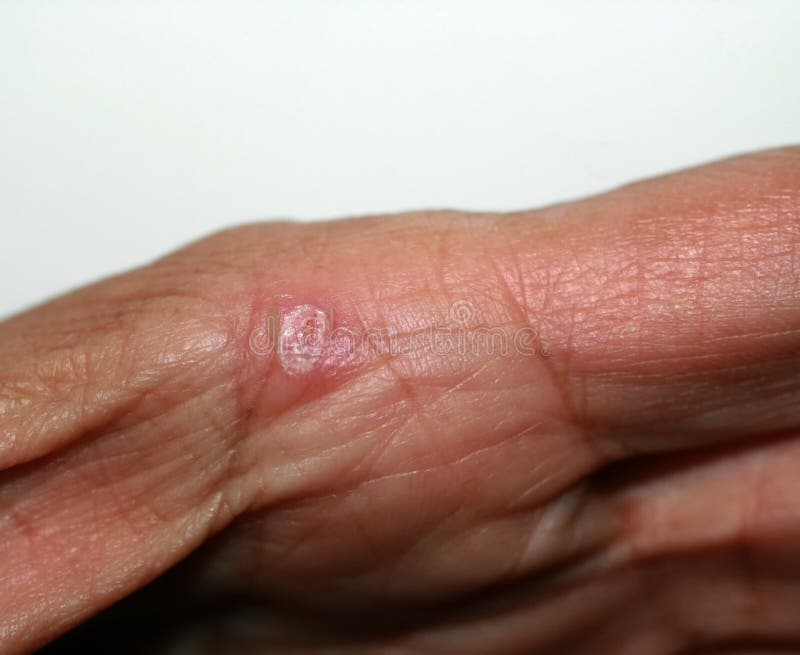 Corn on the Hand. Wound on the Skin. Stock Photo - Image of fungus ...