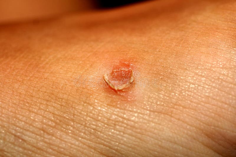 Corn on the Skin. the Corn Popped Stock Photo - Image of human, injury ...