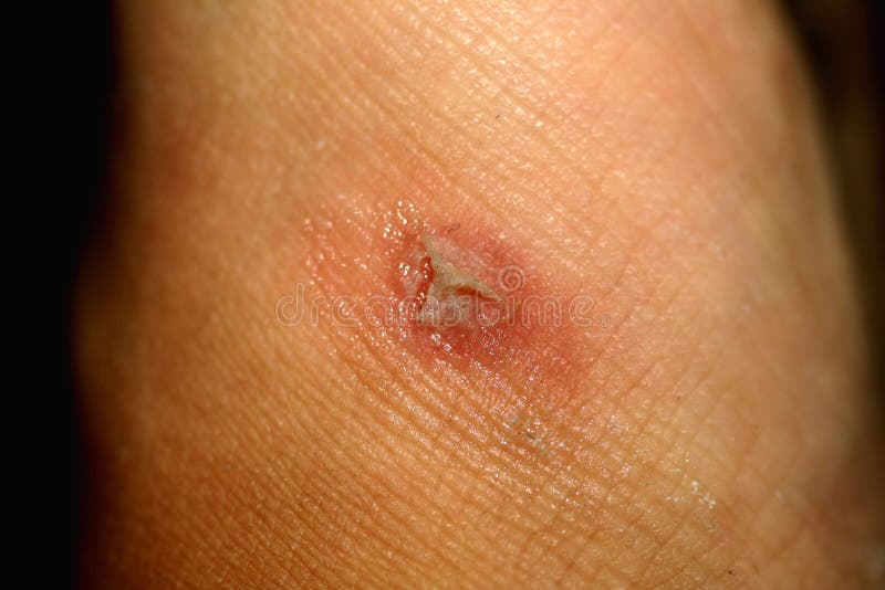 Corn on the Skin. the Corn Popped Stock Photo - Image of human, injury ...