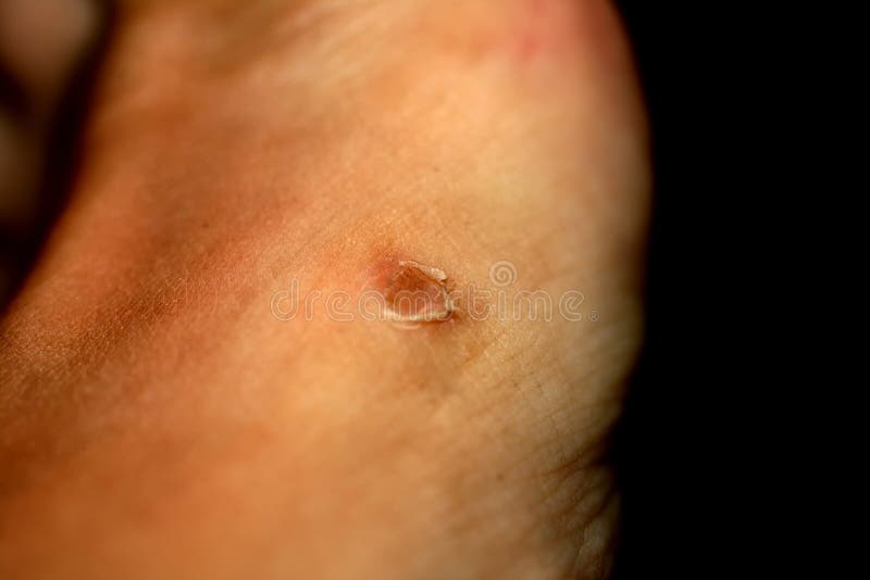 Corn on the Skin. the Corn Popped. Stock Photo - Image of finger ...