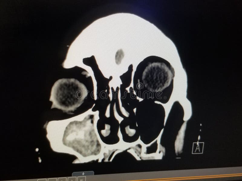 Coronal CT Scan of the Sinuses and Face - Right Maxillary Sinusitis ...