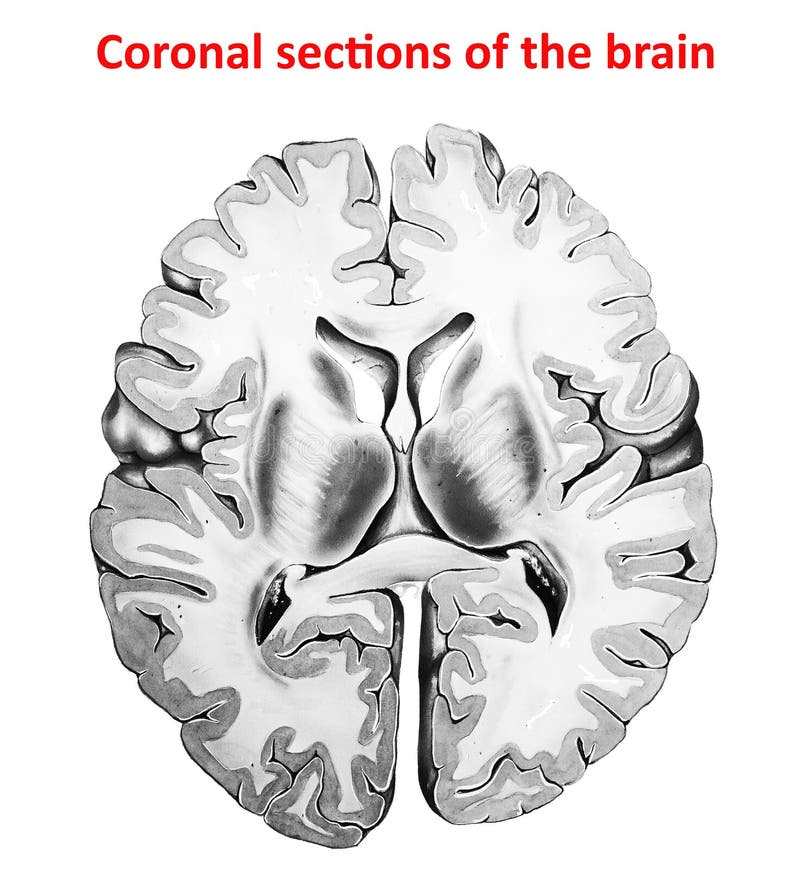 Coronal Section Of Brain Drawing