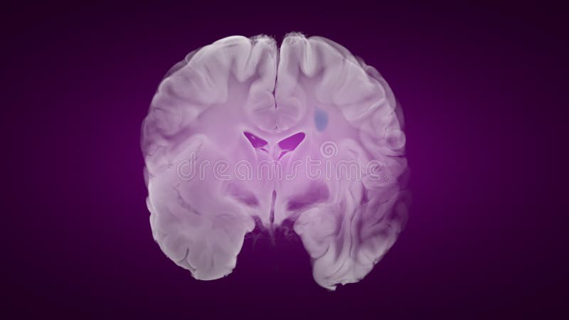 Coronal View of Human Brain with Ischemic Stroke in Blue Tint on White ...