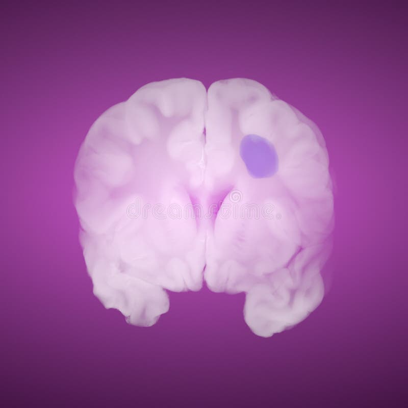 Coronal View of Human Brain with Ischemic Stroke Highlighted in Purple ...