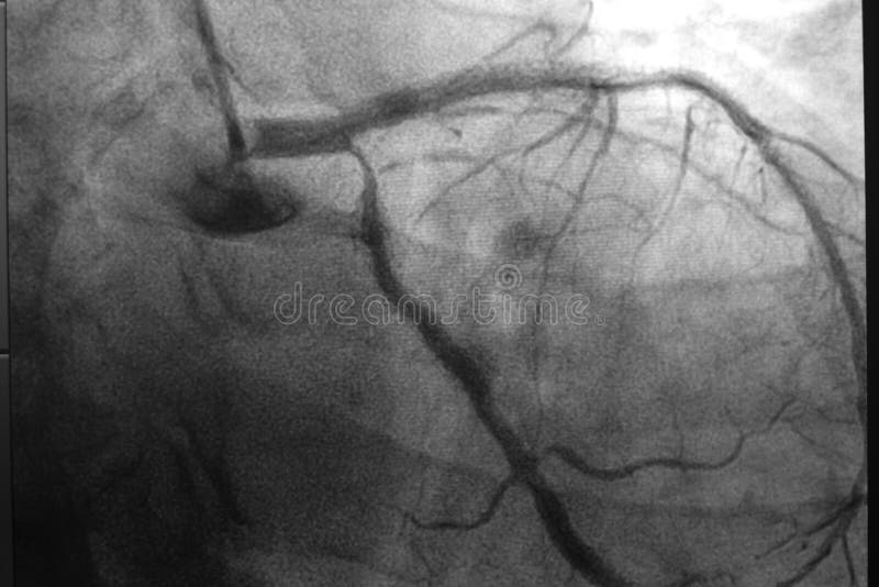 Coronary angiogram stock image. Image of chest, health - 253431751