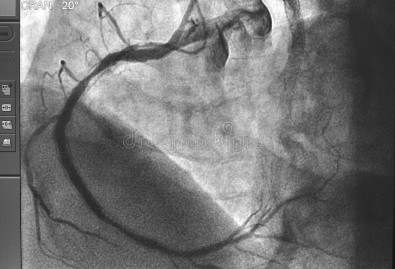 Coronary angiogram stock image. Image of intervention - 253431759