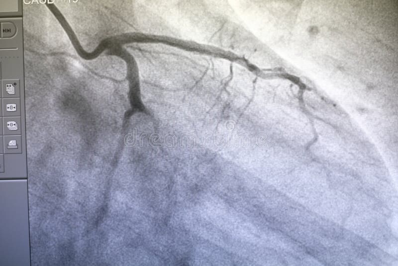 Coronary angiogram stock photo. Image of hospital, imaging - 253431792