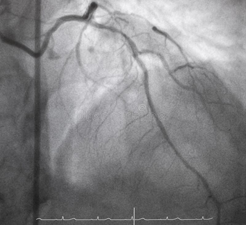 Coronary Angiography. Left Coronary Angiography. Stock Photo - Image of ...
