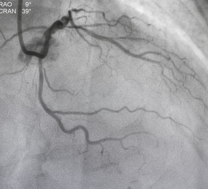 Coronary Angiography. Left Coronary Angiography. Stock Photo - Image of ...
