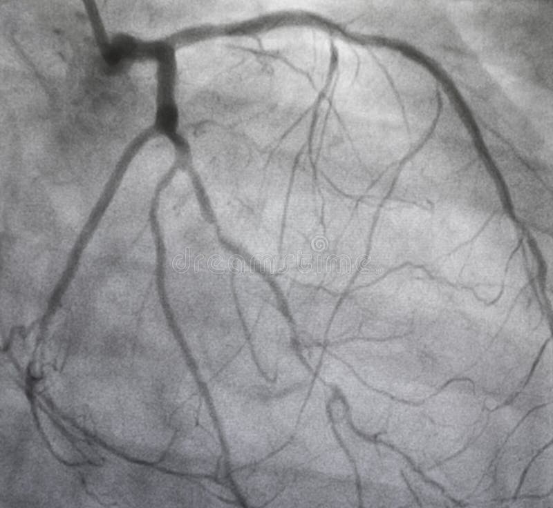 Coronary Angiography. Left Coronary Angiography. Stock Photo - Image of ...