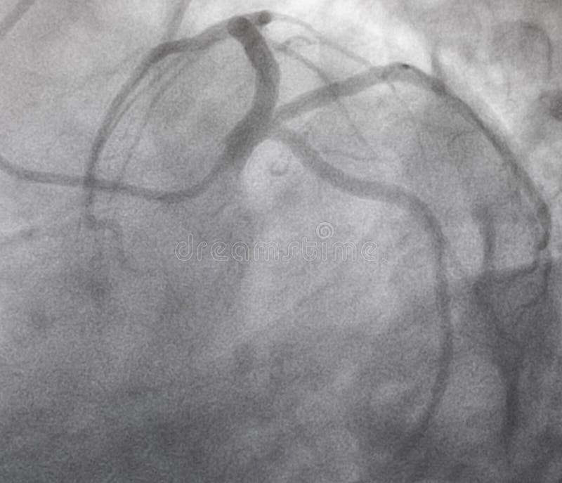 Coronary Angiography. Left Coronary Angiography. Stock Photo - Image of ...