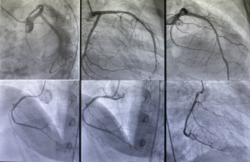 Coronary Angiogram. Medical X-ray Stock Image - Image of circumflex ...