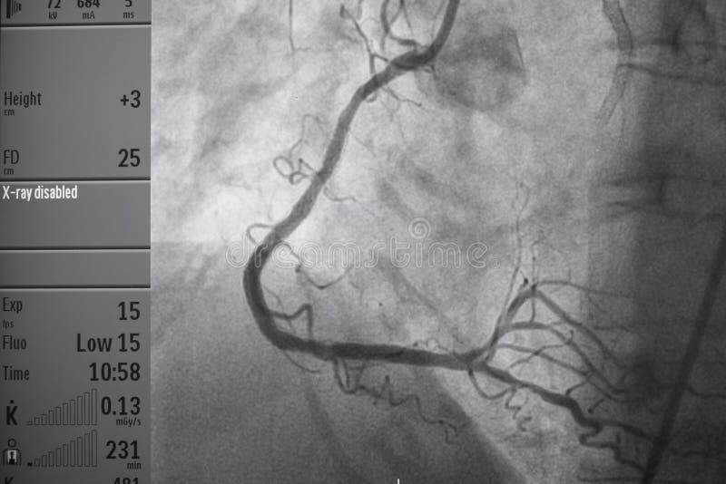 Coronary angiography. stock image. Image of right, artery - 161048821