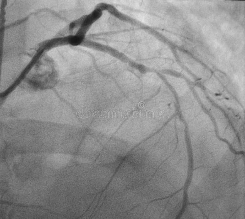 Coronary Angiography. X-ray Image. Stock Illustration - Illustration of ...