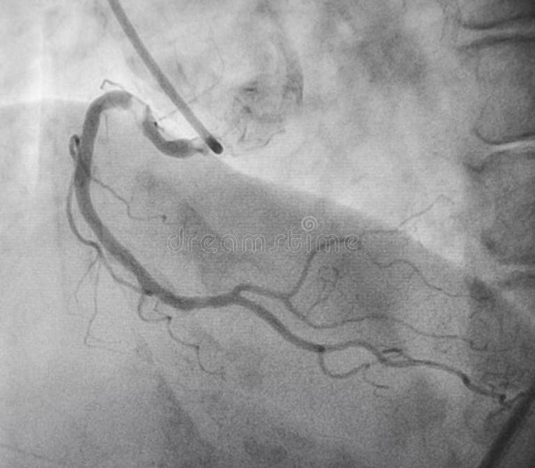 Coronary Angiography Stock Illustrations – 285 Coronary Angiography ...
