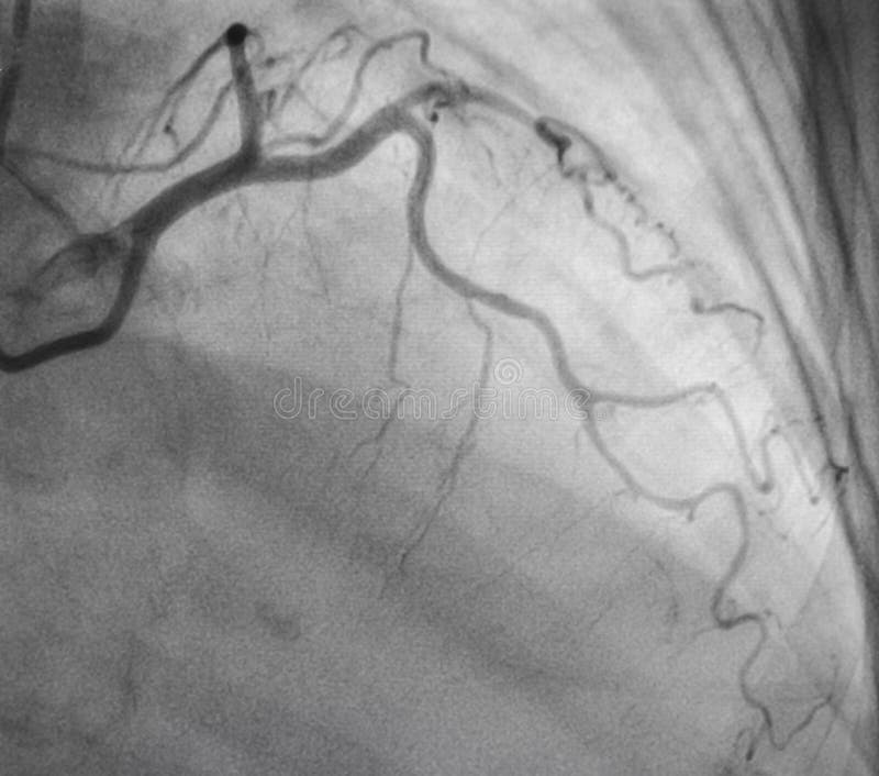 Coronary Angiography. X-ray Image. Stock Illustration - Illustration of ...
