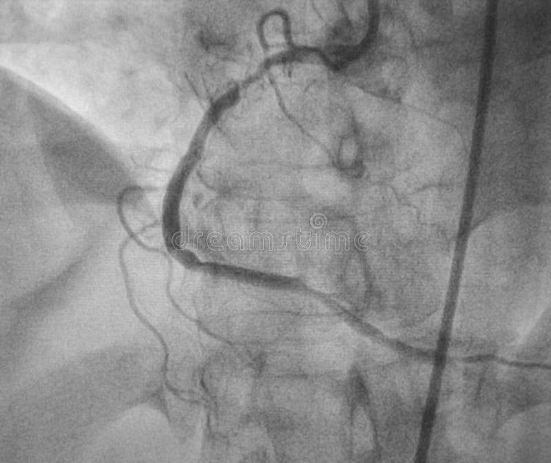 Coronary Angiography. X-ray Image. Stock Illustration - Illustration of ...
