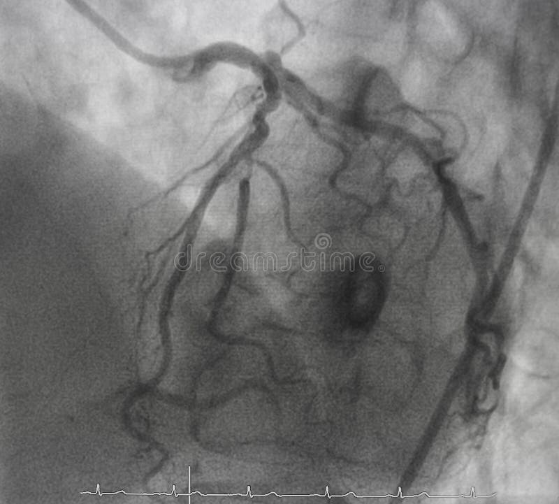 Coronary Angiography. X-ray Image. Stock Illustration - Illustration of ...