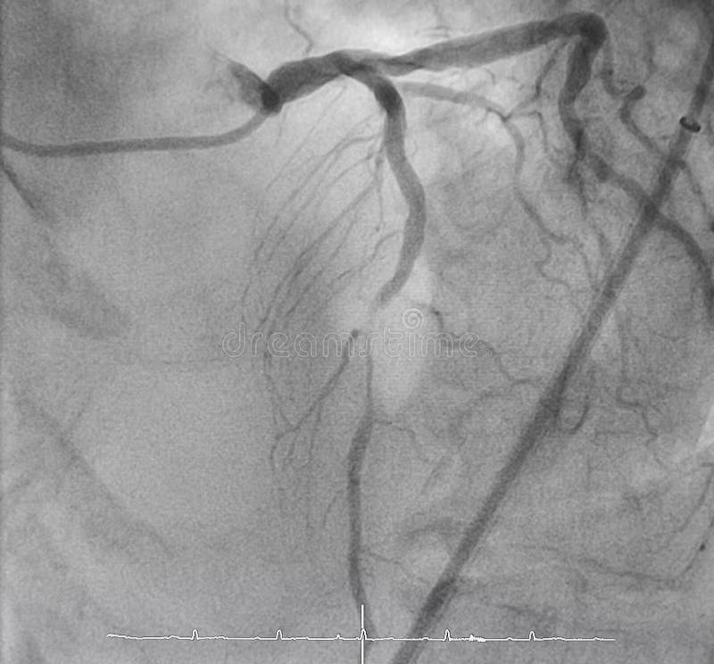 Coronary Angiography. X-ray Image. Stock Illustration - Illustration of ...