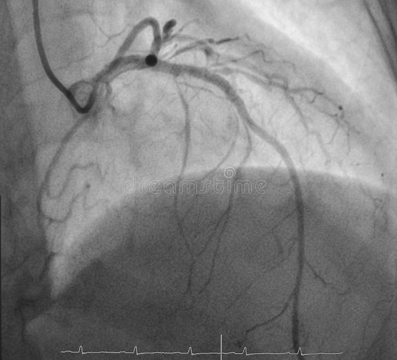 Coronary Angiography. X-ray Image. Stock Illustration - Illustration of ...