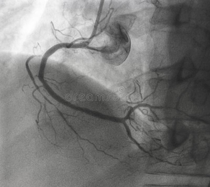 Coronary Angiography. X-ray Image. Stock Illustration - Illustration of ...