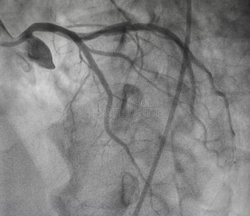 Coronary Angiography. X-ray Image. Stock Illustration - Illustration of ...