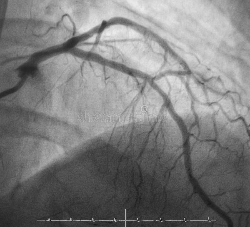 Coronary Angiography. X-ray Image. Stock Illustration - Illustration of ...