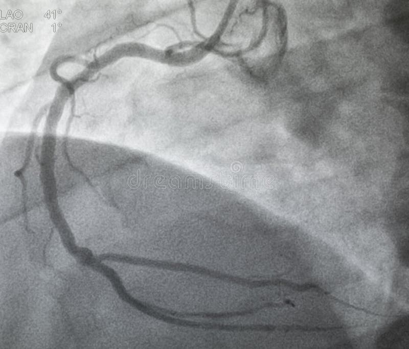 Coronary Angiography. X-ray Image. Stock Photo - Image of hospital ...
