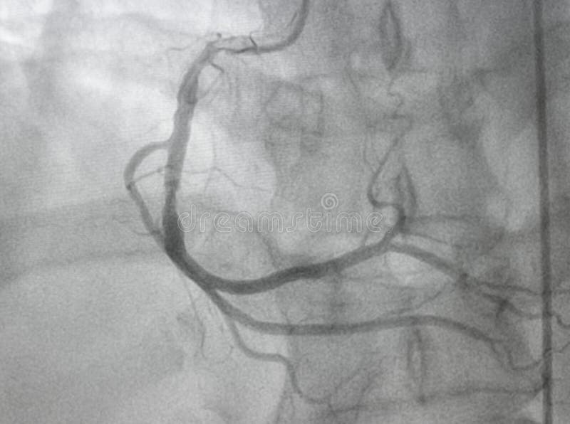 Right Arm Artery Catheterization Angiogramm Ct Stock Photo - Image of ...