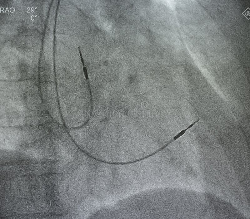 Coronary Angiography. X-ray Image. Stock Image - Image of ...