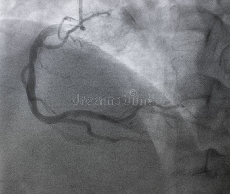 Coronary Angiography.right Coronary Angiography. Stock Photo - Image of ...