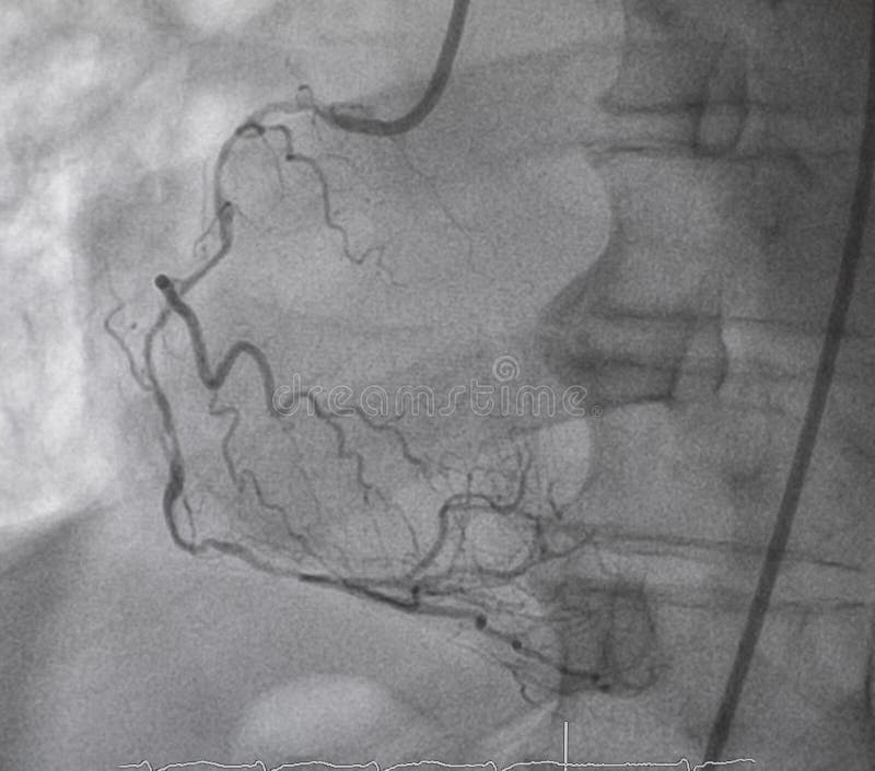 Coronary Angiography. X-ray Image. Stock Photo - Image of catheter ...