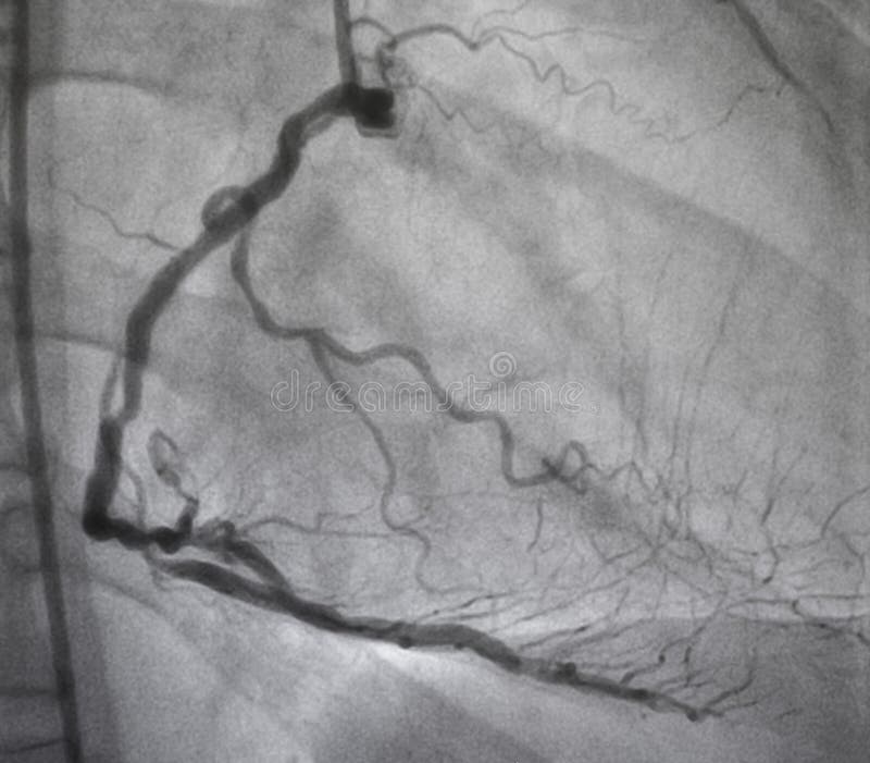 Coronary Angiography.right Coronary Angiography. Stock Photo - Image of ...