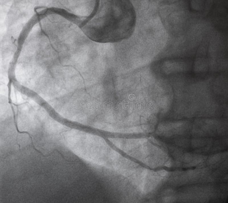 Coronary Angiography.right Coronary Angiography. Stock Image - Image of ...