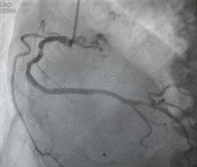 Coronary Angiography. X-ray Image. Stock Image - Image of attack ...