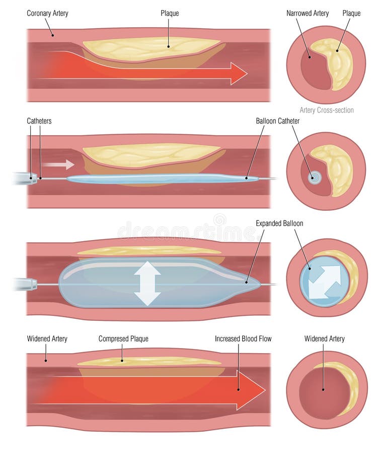 Ballon implantation stock illustration. Illustration of cardiology ...