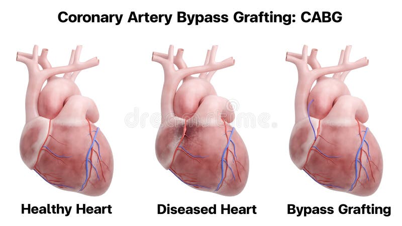 Coronary Artery Bypass Grafting before and after Stock Illustration - Illustration of cabg ...