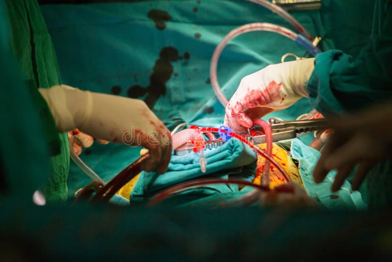 Coronary Artery Bypass Grafting Stock Photo - Image of atherosclerosis ...