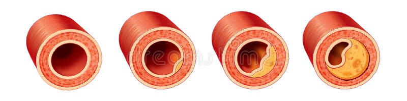 20+ Coronary disease Free Stock Photos - StockFreeImages